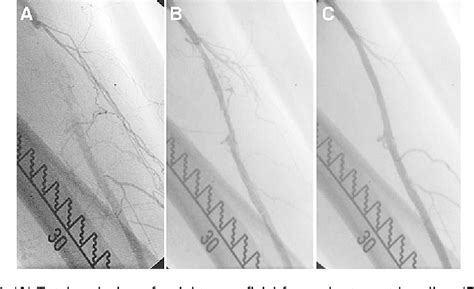 Figure 2 From Percutaneous Rotational And Aspiration Atherectomy In