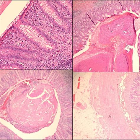 Macroscopically Normal‐looking Appendix Discovered During Diagnostic Download Scientific