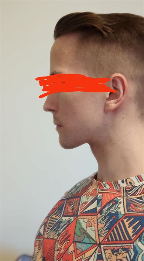 Exactly 2 Months Post Op Sorry About The Quality Old Preop Photos