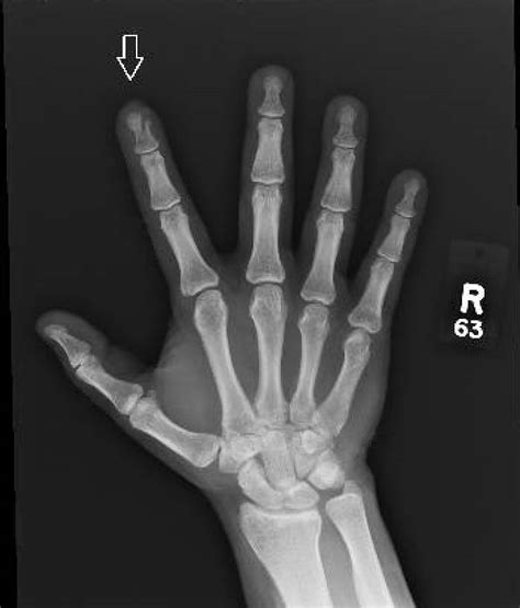 Distal Phalanx Fracture
