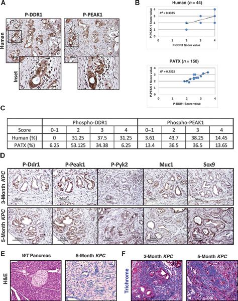 Ddr1 Signaling In Human And Mouse Pda A Ihc Detection Of Phospho Ddr1 Download Scientific Ddr1 Signaling In Human And Mouse Pda A Ihc Detection Of Phospho Ddr1 Download Scientific