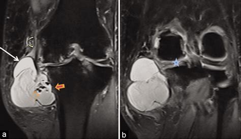 Vacuum Phenomenon In Parameniscal Cyst Masquerading As Infection An
