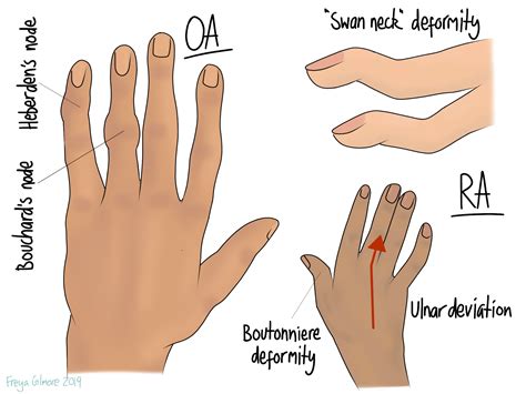 Swan Neck Deformity