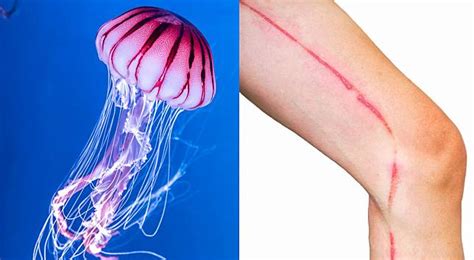 วิธีปฐมพยาบาลเบื้องต้น เมื่อโดนพิษ จาก แมงกะพรุน ควรรู้ไว้