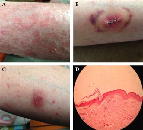 Psoriatic Lesions On Limbs And Histology Of Guttate Psoriatic Patient