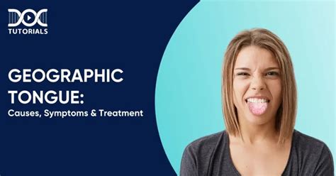 Geographic Tongue Neet Pg Guide Causes Symptoms And Treatment