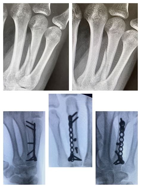 Marcio Aita On Linkedin Metacarpal Shaft Fracture Lag Screws Neutralization Plate Sharing