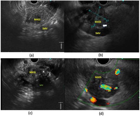 Eus Endoscopic Ultrasound Chronic Pancreatitis At Natalie Hawes Blog