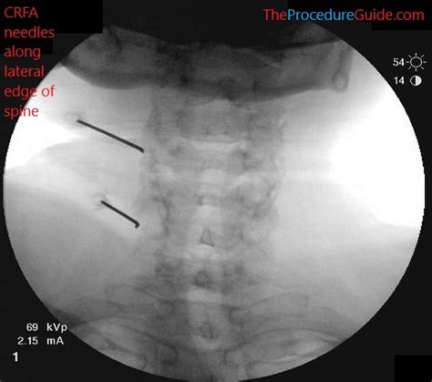 Fluoroscopic Guided Knee Joint Injection Technique And Overview The Procedure Guide