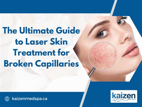 Laser Skin Treatment For Broken Capillaries