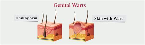 What Are Hpv Genital Warts Signs You Should Know