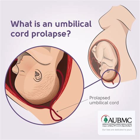 Umbilical Cord Prolapse
