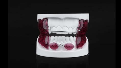 Functional Appliances