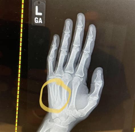 Fracture In Wrist Sugar Tong Splint Needed Rorthopedics