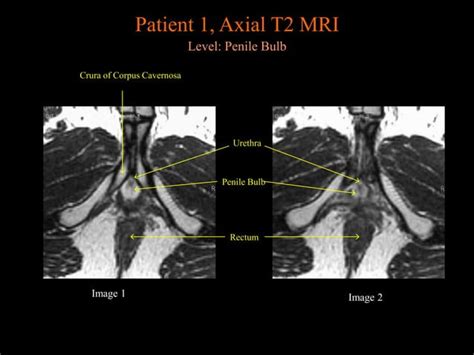 Prostate Mri Anatomy From University Of Michigan Ppt