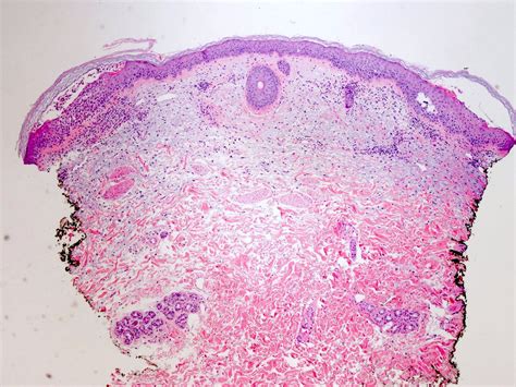 Acute Generalized Exanthematous Pustulosis Histology