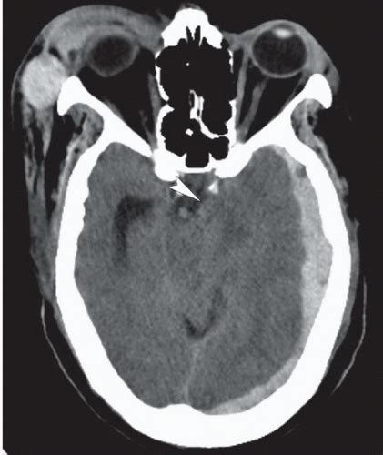 Acute Subdural Hematoma Radiology Key