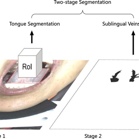 Two Stage Sublingual Veins Segmentation Strategy Download Scientific Diagram