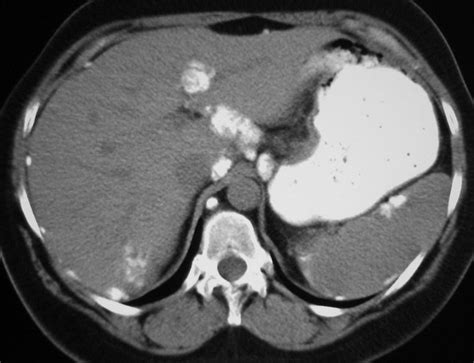 On Radiology Causes Of Calcified Liver Masses On Ct