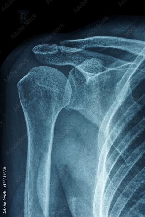 Adhesive Capsulitis X Ray Images At Amparo Roberts Blog