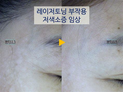 요즘 뜨는 기미레이저 피코토닝 네이버 블로그