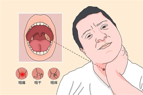 白喉扁桃体 图库 五毛网