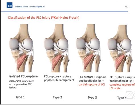 Posterolateral Corner Injuries Of Knee Tips And Tricks