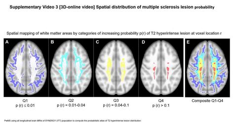 Explain Multiple Sclerosis Brain Mri