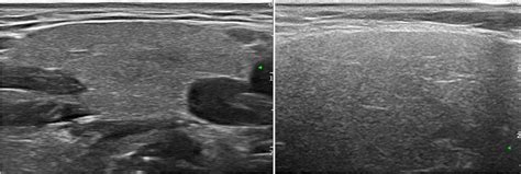 Parotid Gland On Ultrasound
