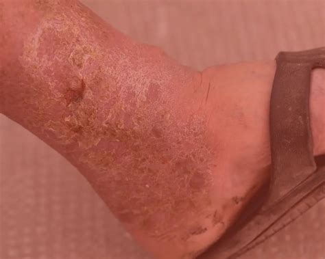 A Guide To Lower Extremity Ulcer Prevention And Treatment Blog