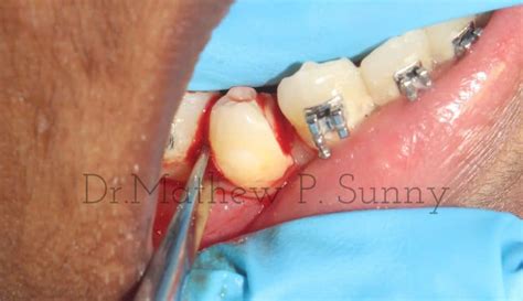 Partially Impacted Premolar Extraction Myzerodonto