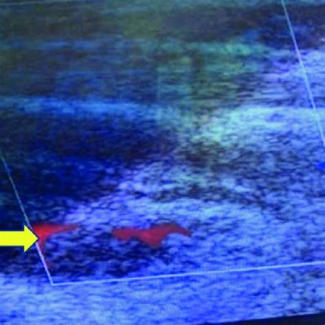 The Image Depicts Diffuse Cerebral Edema That Displaces The Cerebral Download Scientific