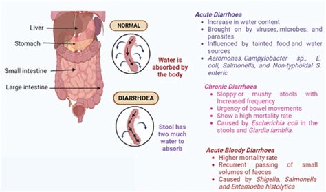 Infectious Diarrhea Causes Infectious Diarrhea Hi Res Stock