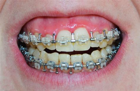 Braces For Hooks At Linda Gary Blog