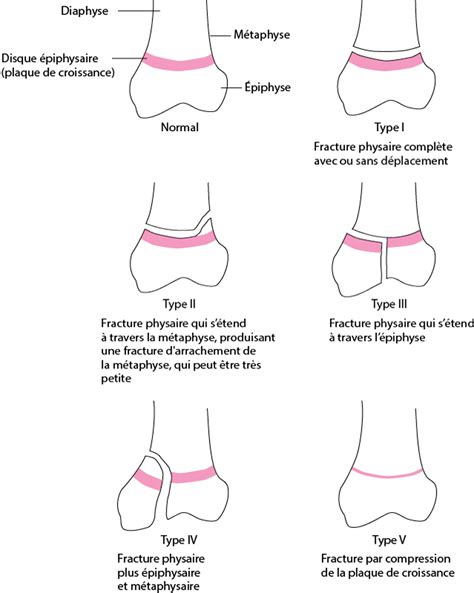 Imageclassification De Salter Harris Pour Les Fractures Décollement