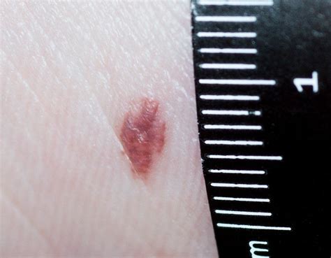 Symptoms Of Skin Cancer