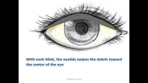 How Do ‘bitots Spots Form Explained In Hindi Youtube