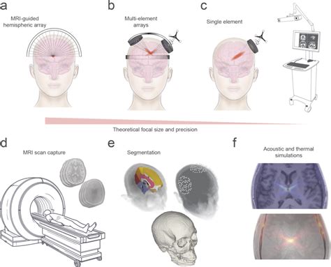 The Promises And Challenges Of Neurotechnology To Improve Human Health