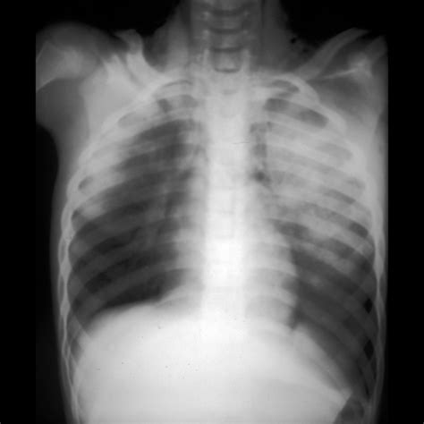 Pediatric Pneumomediastinum Pediatric Radiology Reference Article