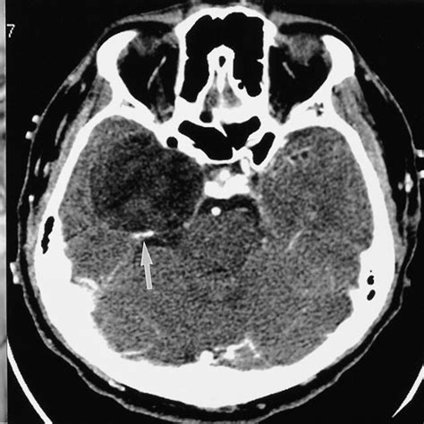 24 Year Old Man With Right Middle Cranial Fossa Mass A Download