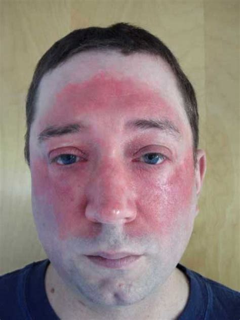 Cellulitis Face