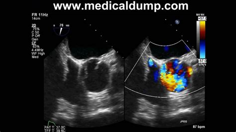 Bicuspid Leaking Valve At Thomas Gabaldon Blog