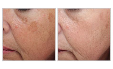 Moxi Laser Sydney Infinity Skin Clinic