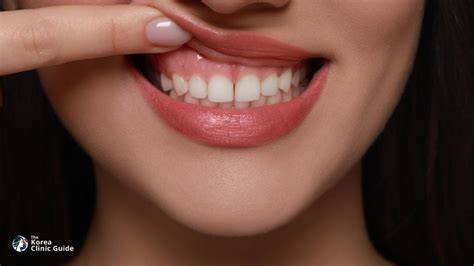 Korea Clinic Guide Gummy Smile Botox