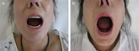 Thinning Lips Scleroderma