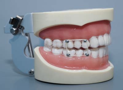 Intermaxillary Elastics With Clear Aligners Types Use