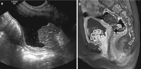 Bladder And Ureteral Imaging Radiology Key