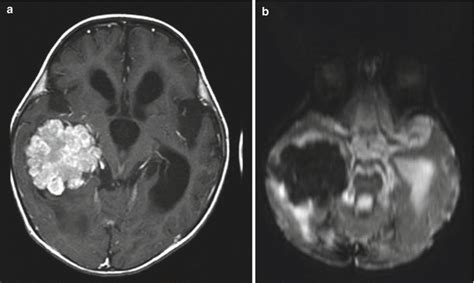 Choroid Plexus Tumors Oncohema Key
