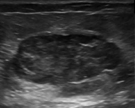 Radiation Associated Angiosarcoma Of The Breast A Clinicopathological