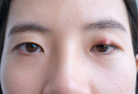 Benjolan Di Kelopak Mata Gejala Penyebab Dan Penanganan Rs Pondok